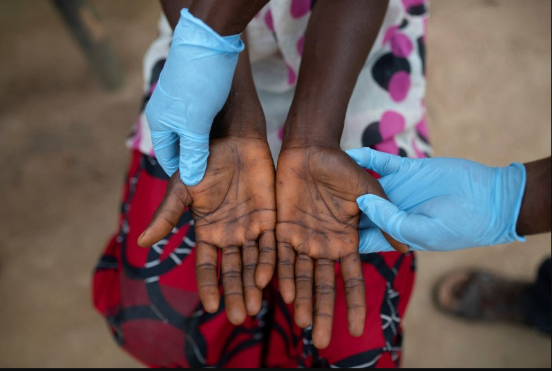 Health officials issue important update on mpox cases detected in ...